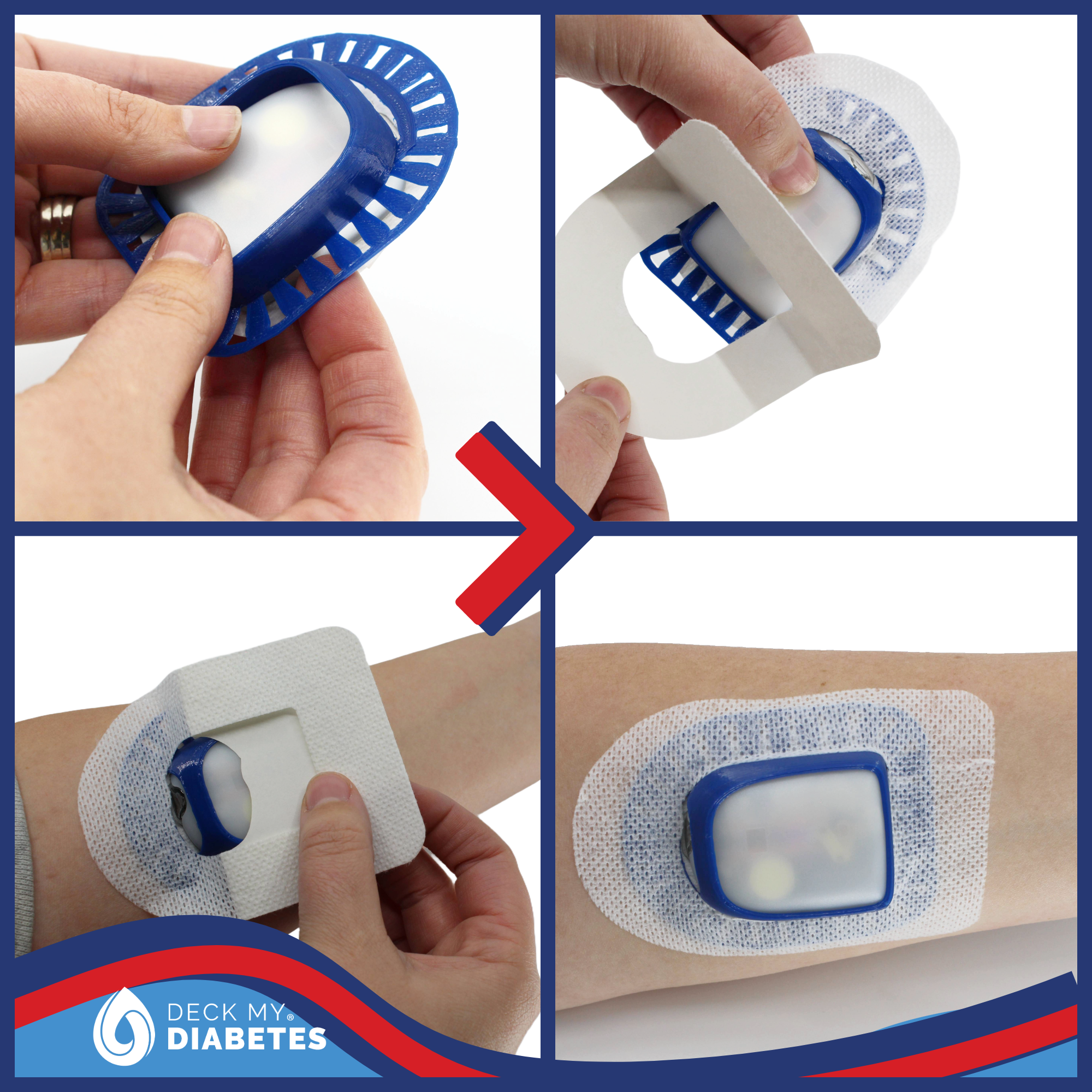 GripShield® Compatible With Insulet’s Omnipod® Insulin Management Syst ...